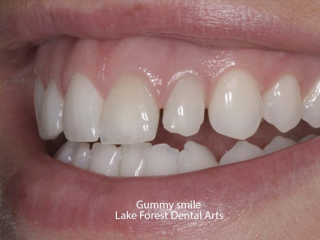 Raise My Gumline | Gum Lift | Repositioning your Gum