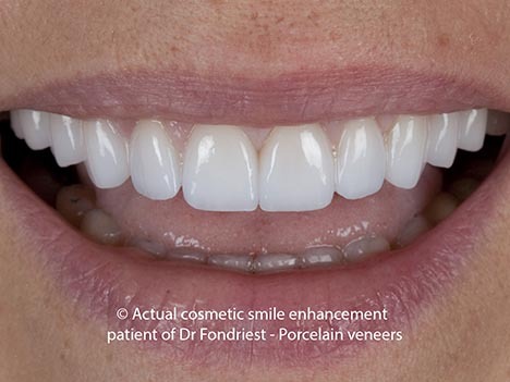 Conservative Porcelain Veneers - Hard to create but worth it