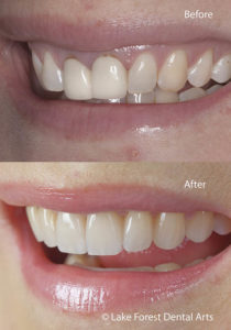 Smile correction treatment | Address cosmetic issues