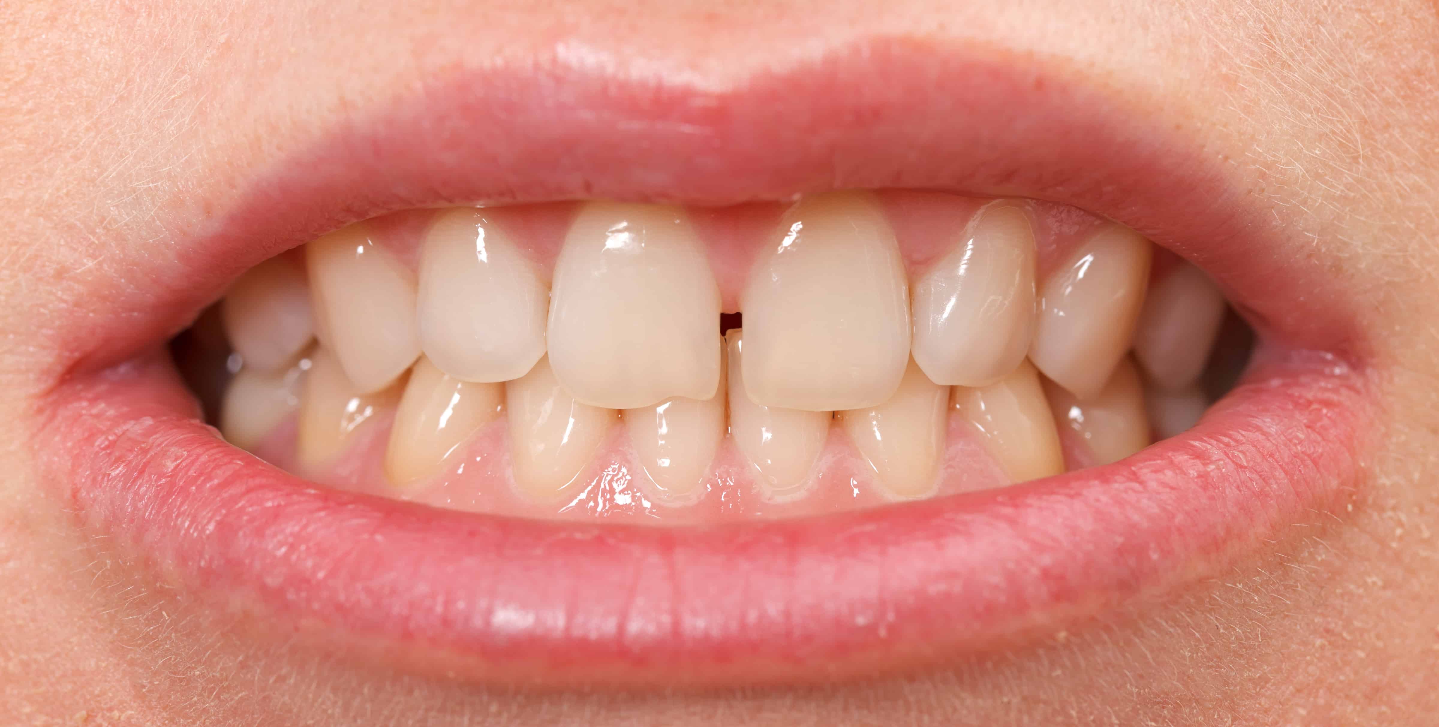Teeth Spaces What Can I Do 