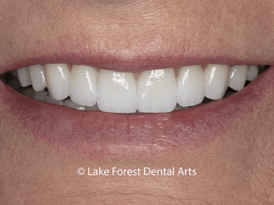 How long do veneers last? | How to preserve their serfvice life