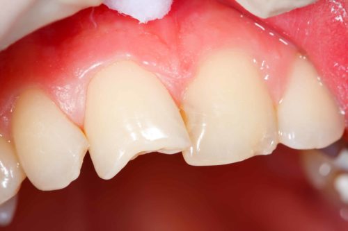 My tooth is broken | What to do when part of a tooth breaks off