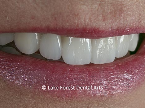 Am I Stuck With the Shape Of My Teeth? Want new tooth shapes?