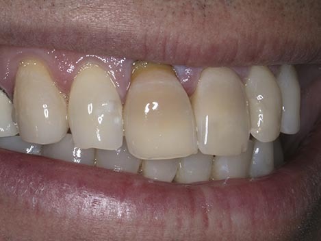 Smile discolorations | Procedures for stains in your smile