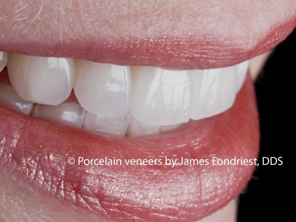 Porcelain Veneers | Types and Uses, How they are made