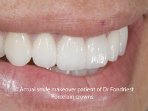 Porcelain Crowns-Types, Uses, Costs | Beautiful and Natural