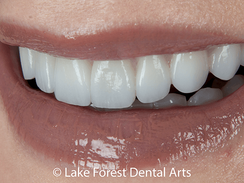 Will Veneers Ruin My Teeth? Dentists often drill too much