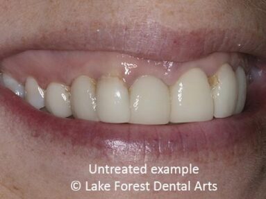 Raise My Gumline | Gum Lift | Repositioning your Gum