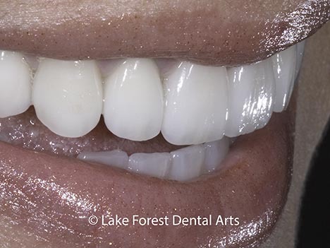 Whiter smile | Benefits | When Is White Too White?