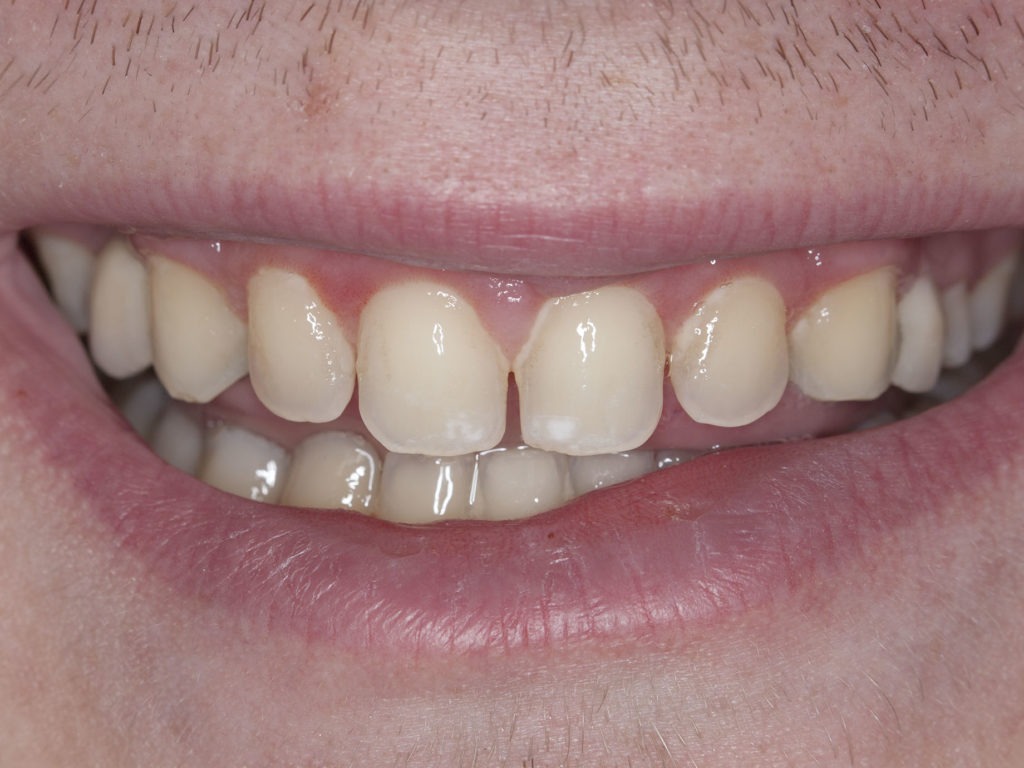 Close my diastema | How Do I Fix My Gapped Teeth?