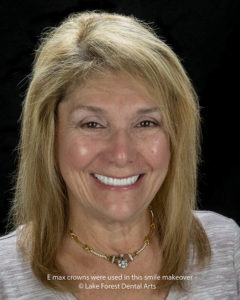 E Max Crowns | Types, Uses for this beautiful porcelain