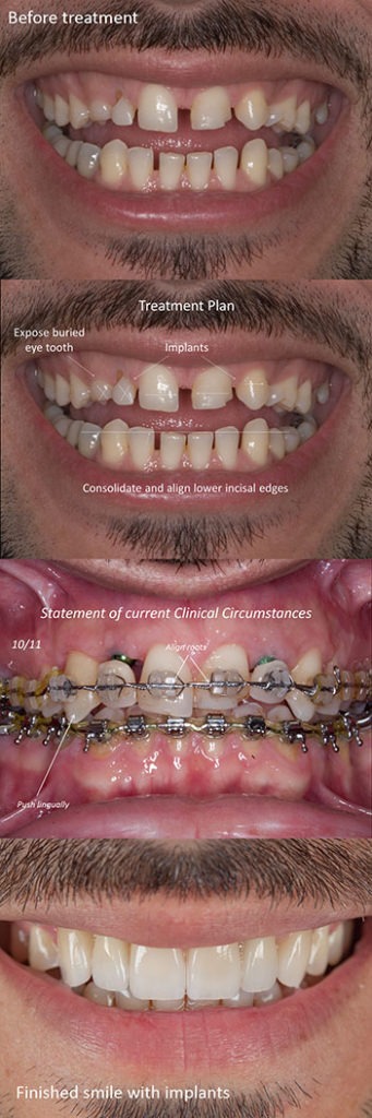 Dental Implants | Chicago Implant Dentist