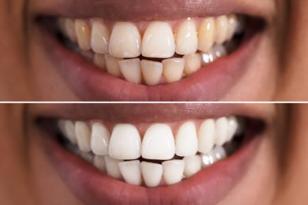 Discolored Teeth | The best treatment options to brighten them