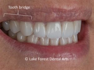 Tooth Bridge | Easy option for replacing a missing tooth