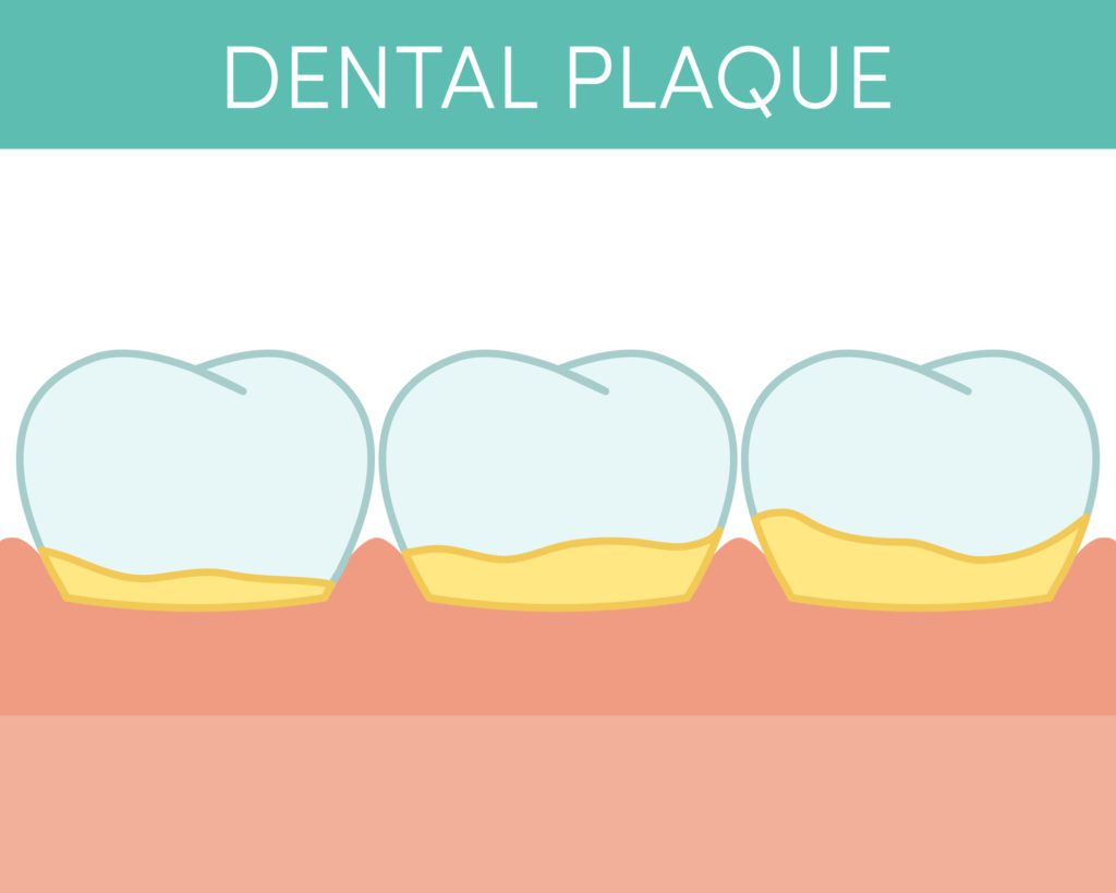 Plaque vs Tartar | What are the differences between them?