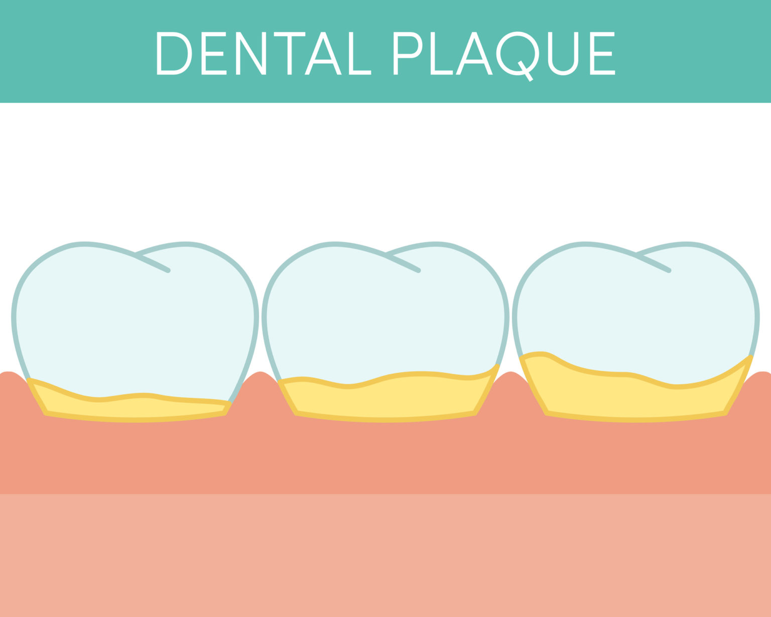Plaque vs Tartar | What are the differences between them?