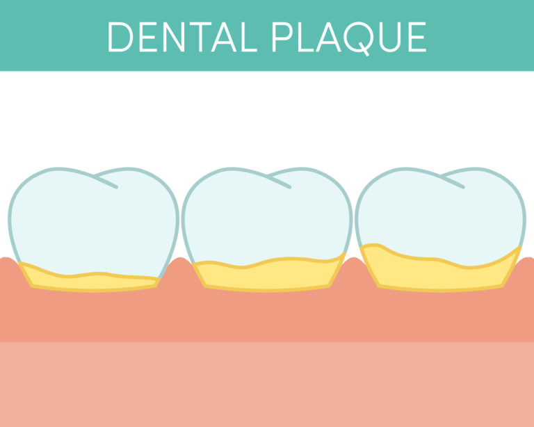 Plaque vs Tartar | What are the differences between them?